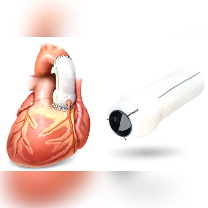 Durable Ascending Aorta Vascular Prosthesis Sale or Rent Near Me ...
