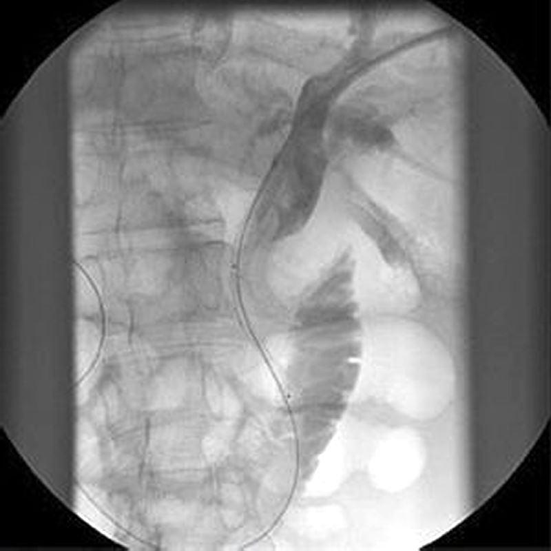 Durable Biliary Stent Sale or Rent Near Me – Goldstar Medical Equipment ...