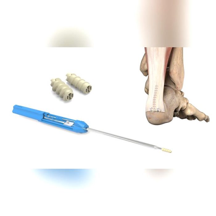 Durable Calcaneal Tendon Suture Anchor Sale or Rent Near Me – Goldstar ...