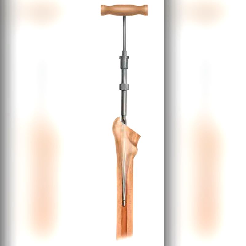 Durable Cemented Femoral Stem Sale or Rent Near Me – Goldstar Medical ...