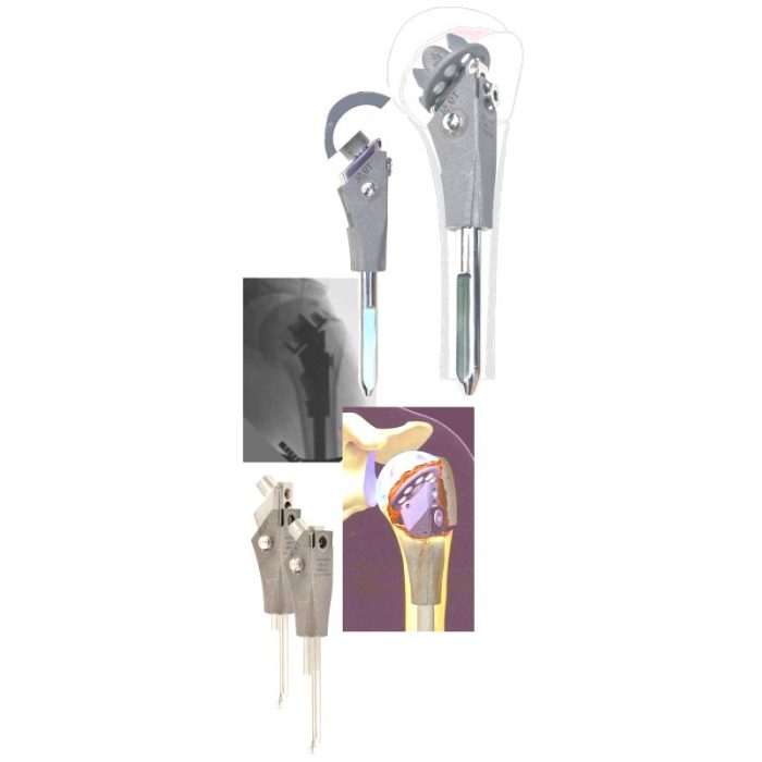 Durable Cementless Shoulder Prosthesis Sale or Rent Near Me – Goldstar ...