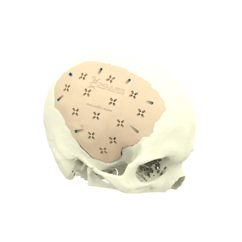 Durable Custom-Made Cranial Implant Sale or Rent Near Me – Goldstar ...