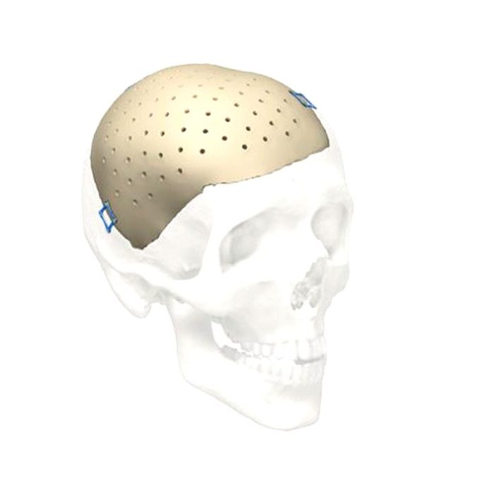 Durable Custom-Made Cranial Implant Sale or Rent Near Me – Goldstar ...