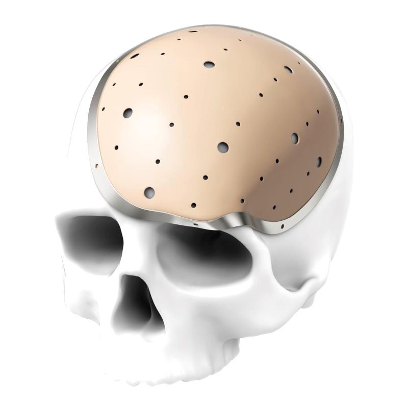 Durable Custom-Made Cranial Implant Sale or Rent Near Me – Goldstar ...