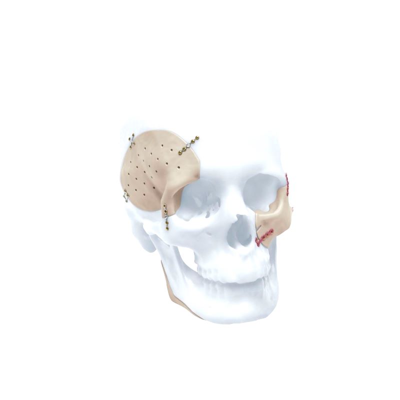Durable Custom-Made Cranial Implant Sale or Rent Near Me – Goldstar ...