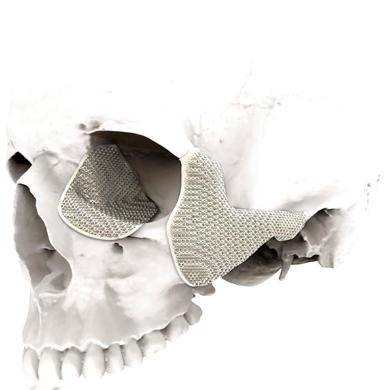 Durable Custom-Made Cranial Implant Sale or Rent Near Me – Goldstar ...