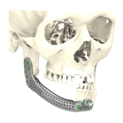 Durable Custom-Made Mandibular Implant Sale or Rent Near Me – Goldstar ...