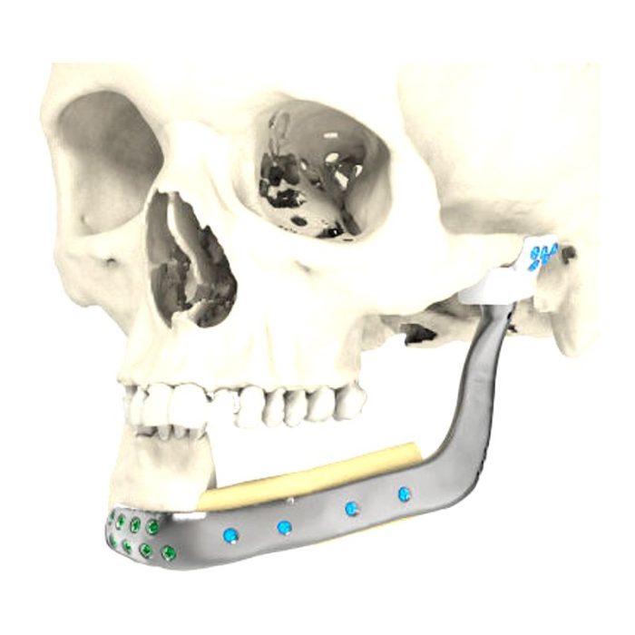 Durable Custom-Made Mandibular Implant Sale or Rent Near Me – Goldstar ...