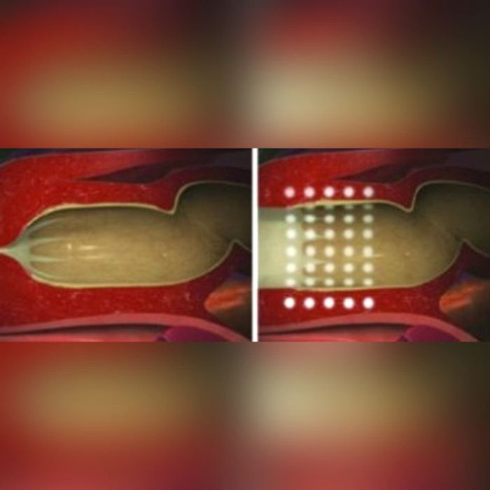 Durable Fecal Incontinence Treatment Endoscopic Surgical System Sale or ...