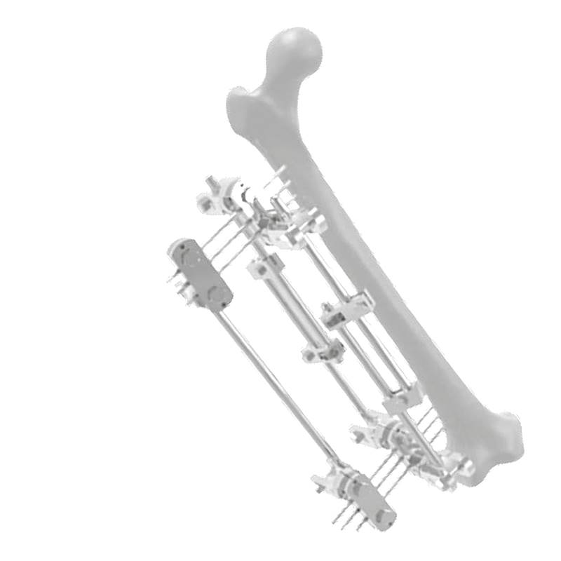 Durable Femur External Fixation System Sale or Rent Near Me – Goldstar ...
