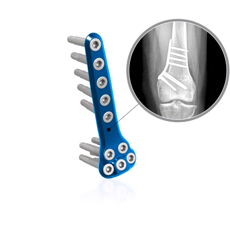 Durable Hallux Valgus Osteotomy Plate Sale or Rent Near Me – Goldstar ...
