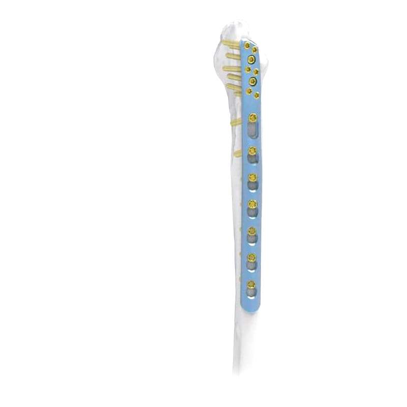 Durable Fibula Compression Plate Sale or Rent Near Me – Goldstar ...