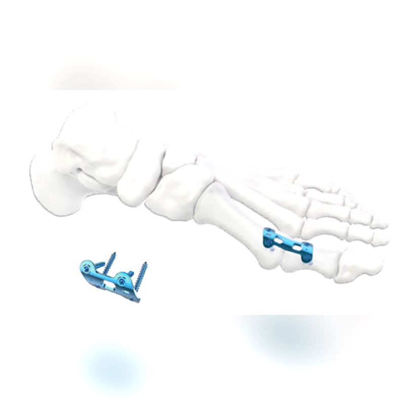 Durable Hallux Valgus Arthrodesis Plate Sale or Rent Near Me – Goldstar ...