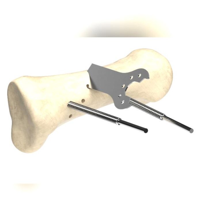 Durable Hallux Valgus Osteotomy Plate Sale or Rent Near Me – Goldstar ...