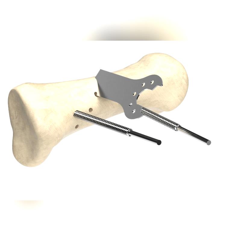 Durable Hallux Valgus Osteotomy Plate Sale or Rent Near Me – Goldstar ...