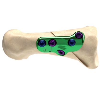 Durable Hallux Valgus Osteotomy Plate Sale or Rent Near Me – Goldstar ...