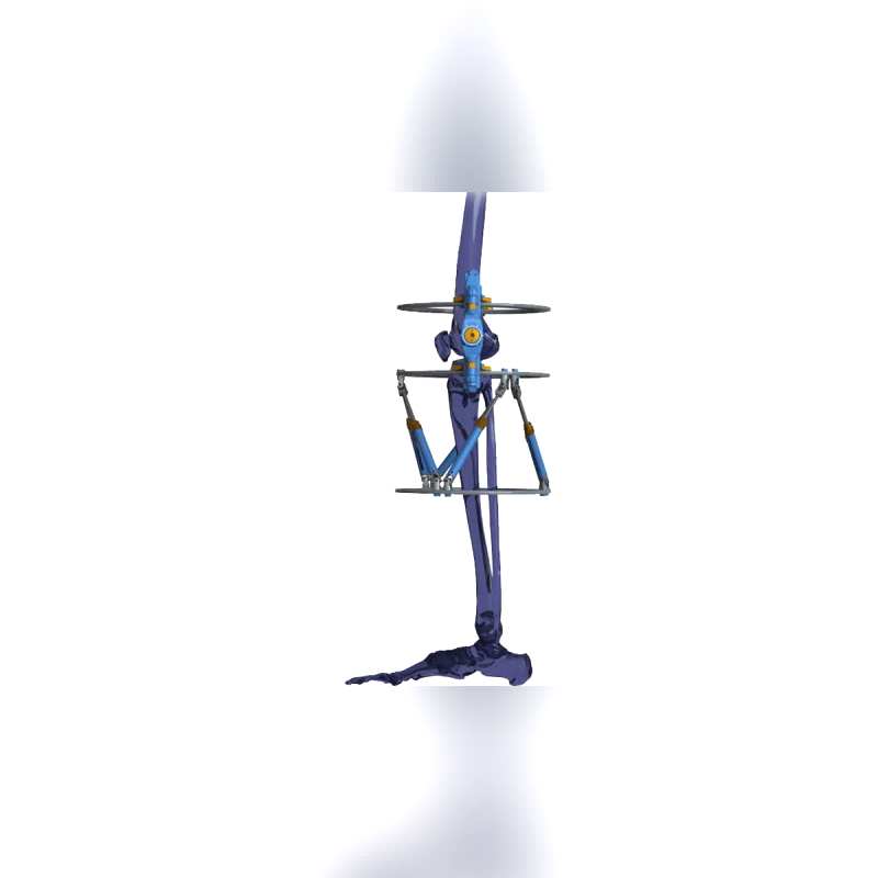 Durable Knee External Fixation System Sale or Rent Near Me – Goldstar ...