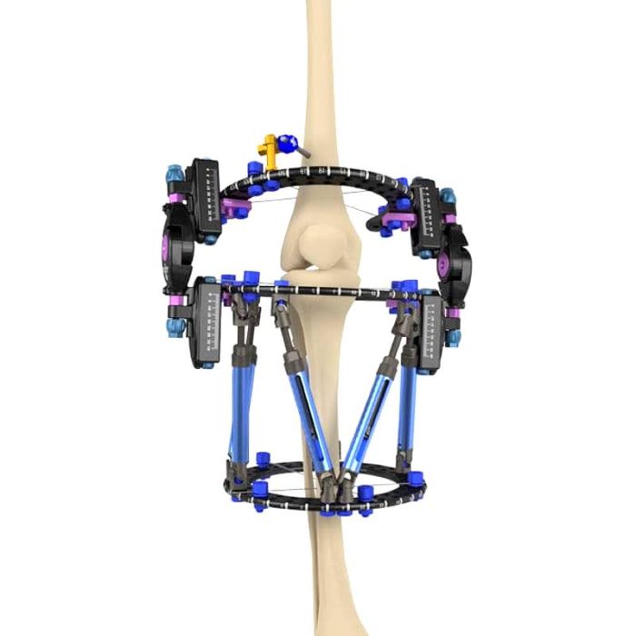 Durable Knee External Fixation System Sale or Rent Near Me – Goldstar ...
