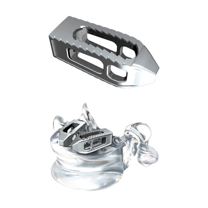 Durable Lumbo-Sacral Interbody Fusion Cage Sale or Rent Near Me ...