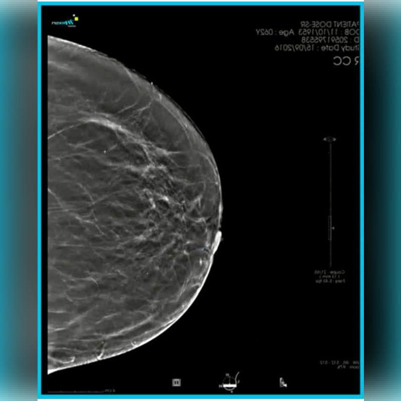 Durable Mammography Software Module Sale or Rent Near Me – Goldstar ...