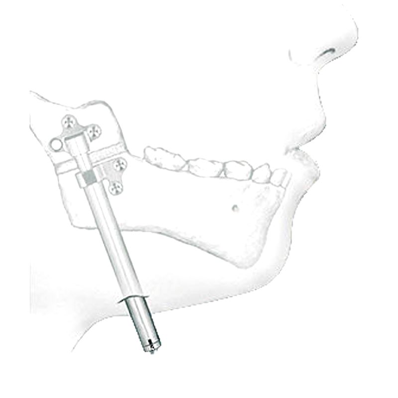 Durable Mandibular Distractor Sale or Rent Near Me – Goldstar Medical ...