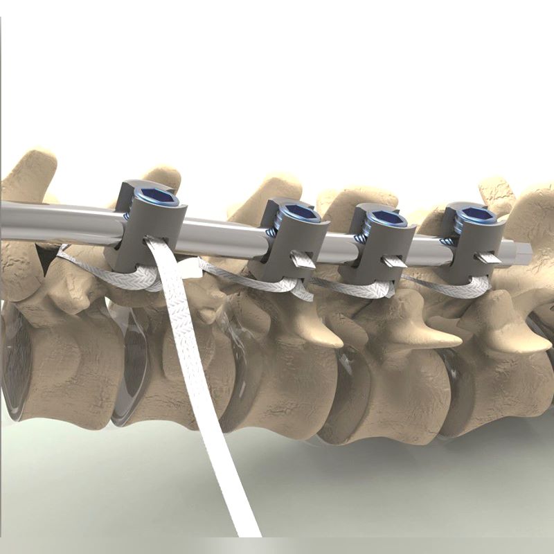 Durable Pediatric Posterior Spinal Fixation Band Sale or Rent Near Me ...