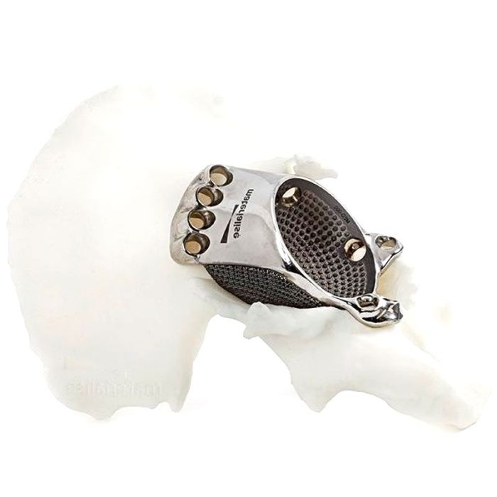 Durable Revision Glenoid Cavity Prosthesis Sale or Rent Near Me ...