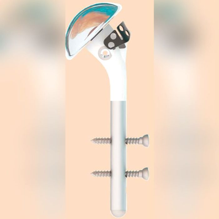 Durable Revision Humeral Stem Sale or Rent Near Me – Goldstar Medical ...