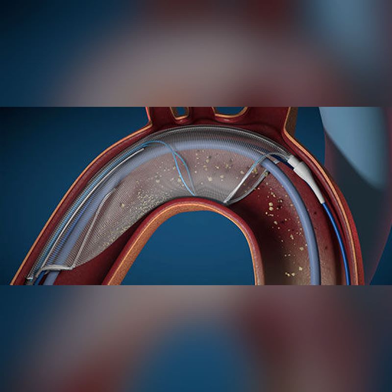 Durable Ultrasound Atherectomy Catheter Sale or Rent Near Me – Goldstar ...